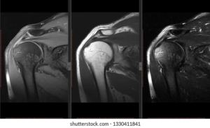 MRI SHOULDER(S) – ScanLab Center