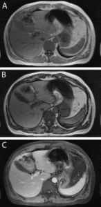 MRI UPPER ABDOMEN – ScanLab Center